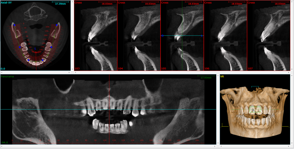 CBCT:la tomografia computerizzata cone beam – Wisildent